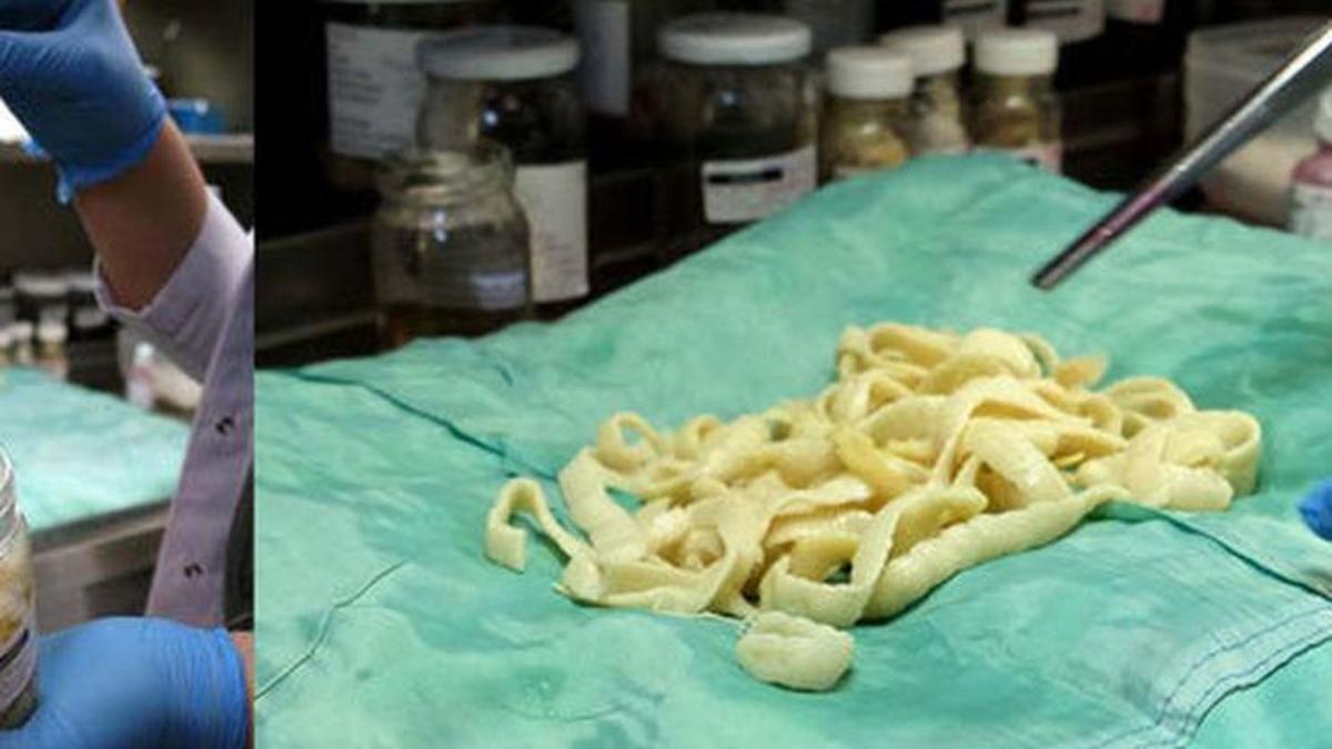 Tenya nedir ve neden oluşur? Tenya nasıl kaybedilir, tenya nasıl tedavi ...